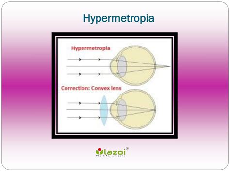 Ppt Hypermetropia Causes Symptoms Daignosis Prevention And Treatment Powerpoint