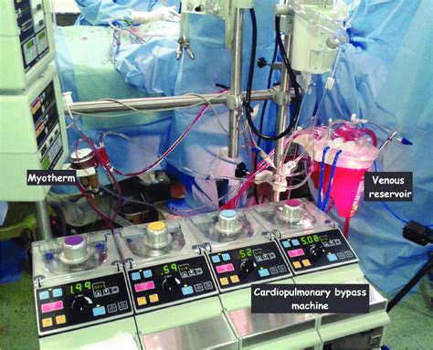 Cardiopulmonary Bypass Machine