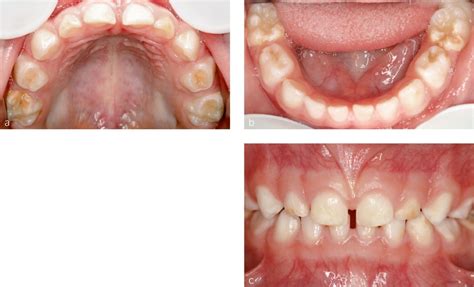 Hypomineralized Primary Molars Pocket Dentistry