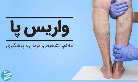 واریس چیست؟ از علت و علائم تا درمان واریس پا