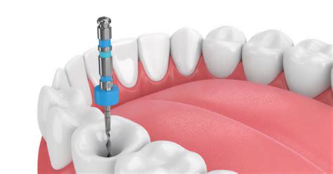 Modern Standards Of Endodontic Treatment