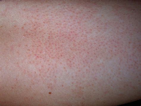 Keratosis Pilaris Types Symptoms Causes Treatment