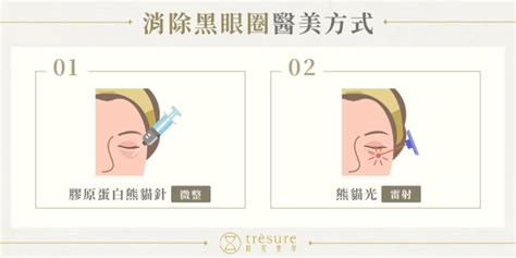 黑眼圈消除怎麼做2 大熱門醫美方式詳解幫你簡單告別熊貓眼