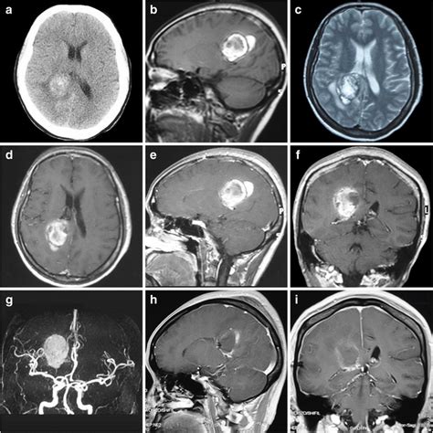 Case 12 Axial Ct A Demonstrating A Hyper Density Lesion Located In