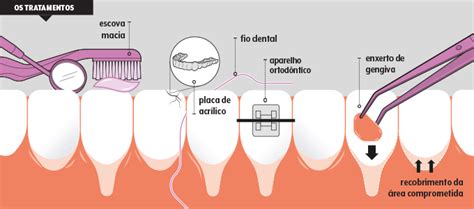 O Que é E O Que Causa A Retração De Gengiva