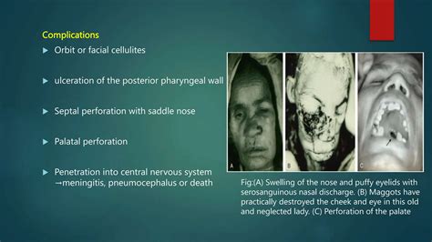 Myiasis In Ear Nose Throat And Hns Pptx