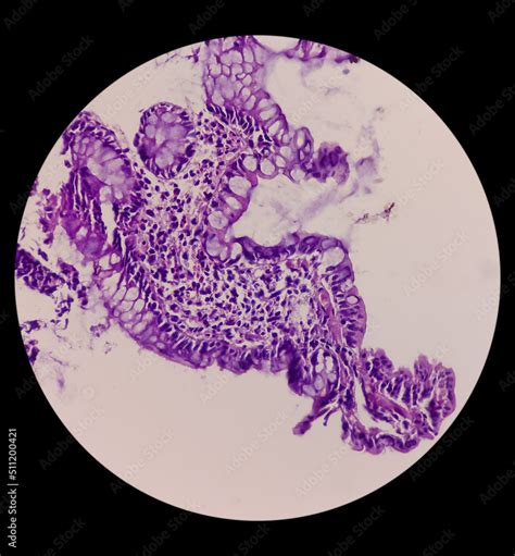 Terminal Ileum Biopsy Chronic Nonspecific Ileitis Or Inflammation Of Ileum Show Ileal Mucosa
