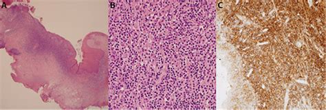 A Hyperplastic Squamous Epithelium Overlying A Dense Download