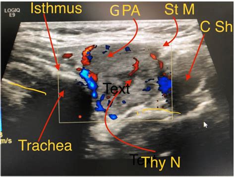 Ultrasound Of Thyroid Nodule And Parathyroid Adenoma Showing