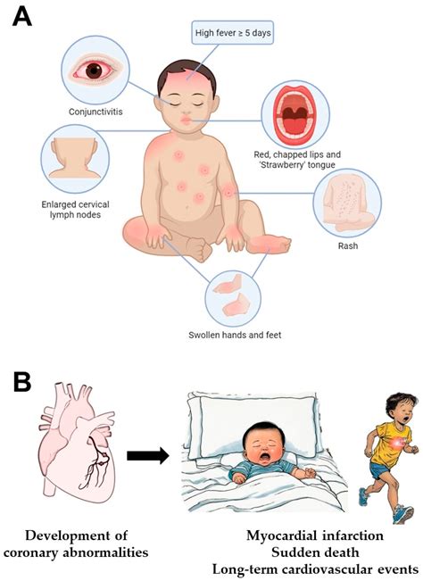 Kawasaki Disease Resurgence Of Kawasaki Disease Following Relaxation