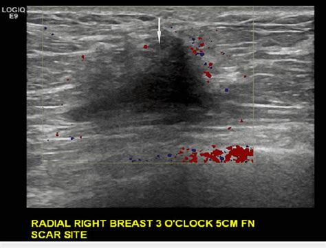Targeted Ultrasound Of The Right Breast At The Site Of Mammographic