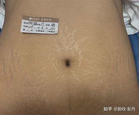 什么都不做，妊娠纹会自己慢慢消失吗 知乎