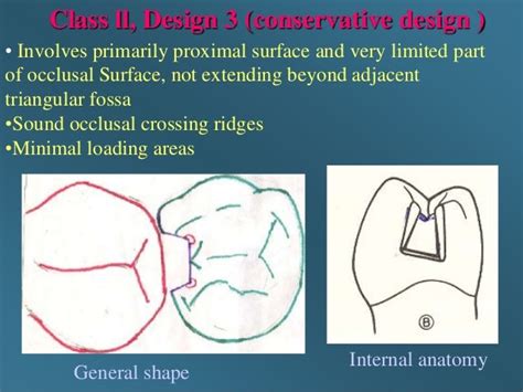 Amalgam Cavity Design