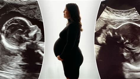 Alabama Woman With Rare Double Uterus Prepares To Give Birth To Her