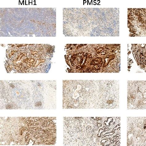 In Case 10 The Ihc Testing Results Of The First Gastroscopy Were