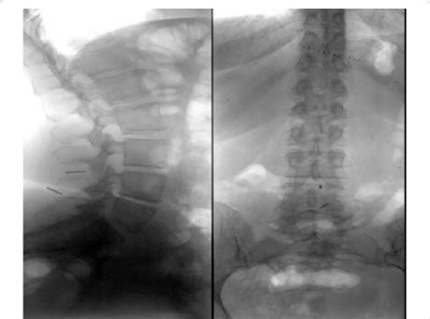 Lumbosacral X Rays In Antero Posterior And Lateral Views That Shows The