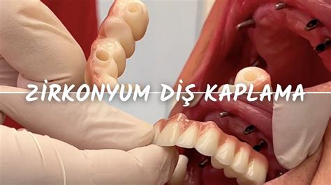 İmplant Üstü Zirkonyum Diş Kaplama YouTube