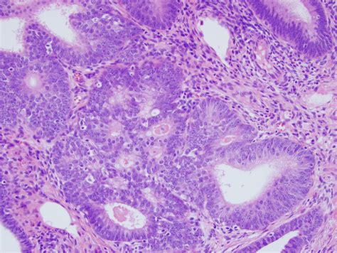 Case Of The Month An Unusual Colon Polyp University Of Rochester Medical Center