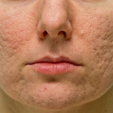 How To Reduce The Appearance Of Acne Scars
