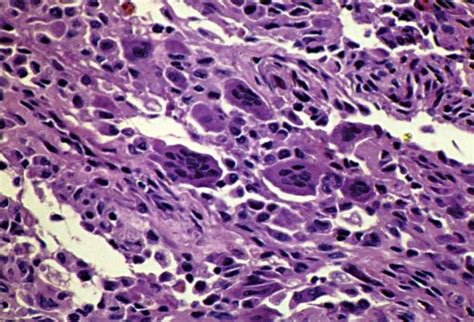 Multinucleated Giant Cells And Histiocytes He 40× Download