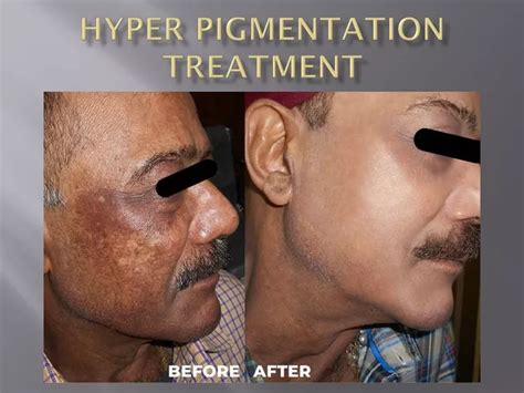 Ppt Hyper Pigmentation Treatment Powerpoint Presentation Free