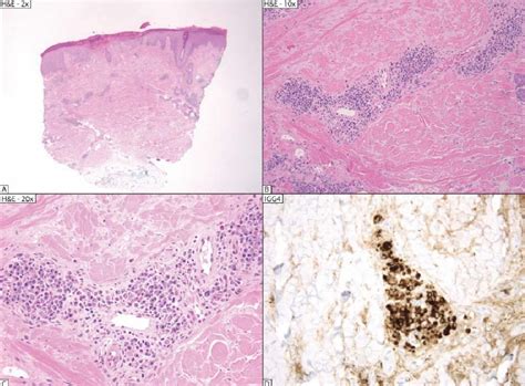 Figure 1 From Myocardial Ischemia Without Evidence Of Obstruction Myocardial Ischemia Without