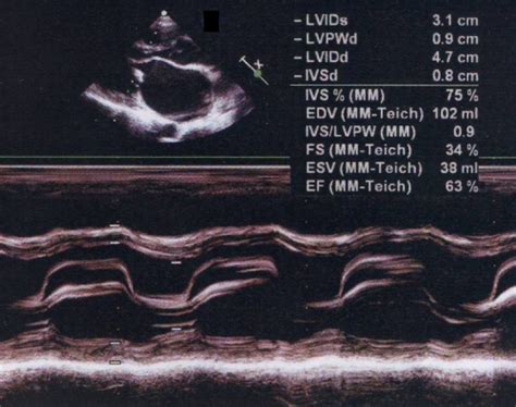 M Mode Echocardiogram In Mitral Stenosis