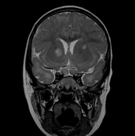 Optic Glioma Radiology Astrocytic Tumors Radiology Key