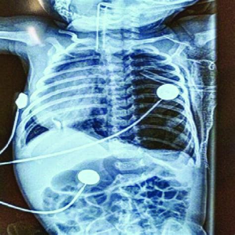 Initial Chest Radiograph Showing Large Hyperlucency In Left Hemithorax