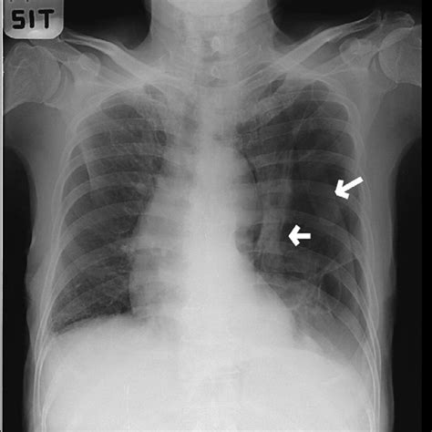 Chest Radiograph Showing Left Pneumothorax With Shift Of The Download Scientific Diagram