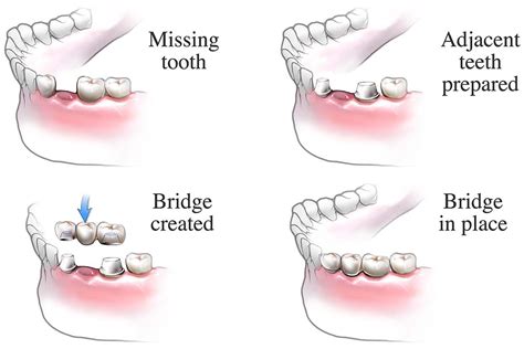 How Do Dental Bridges Stay In Place Dentist Norcross And Alpharetta Ga