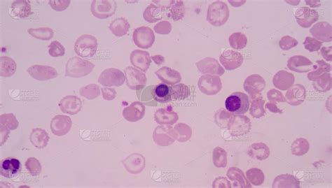 贫血患者的血液涂片素材 花瓣网