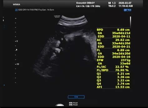 임신 35주 막달검사 여전히 역아 양수량 아기무게 아기크기 심박수 송파고은빛 산부인과 네이버 블로그