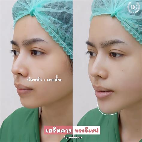 🍑 เสริมคาง โปรรีวิว 🍑 แถมฟรี‼️โบท็อกซ์ลดกราม ไม่จำกัดยูนิต 🏮 พร้อมรายการของแถมอีกมากมาย 👌🏻ฟรี