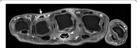 Example Mr Image Of Extensor Tenosynovitis At Mcp 4 Arrow And Flexor Download Scientific