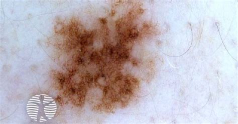 Dermoscopy Reticular Pattern Image