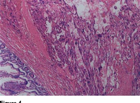Figure 1 From World Journal Of Surgical Oncology Unusual Presentation