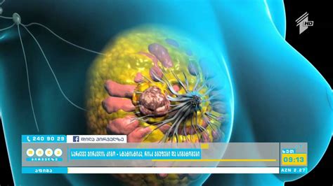 როგორია სარძევე ჯირკვლის სიმსივნის სტატისტიკა რისკ ჯგუფები და