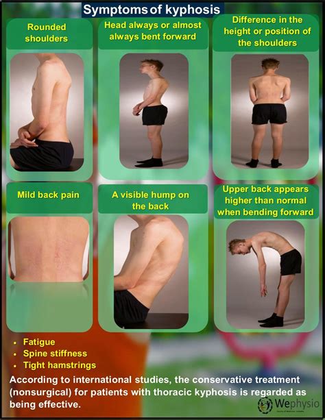 Kyphosis Treatment Options What You Need To Know