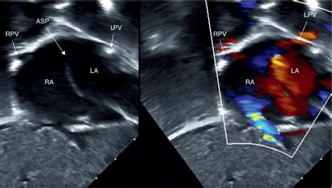 30 Cardiac Malposition And Heterotaxy Syndrome Veterian Key