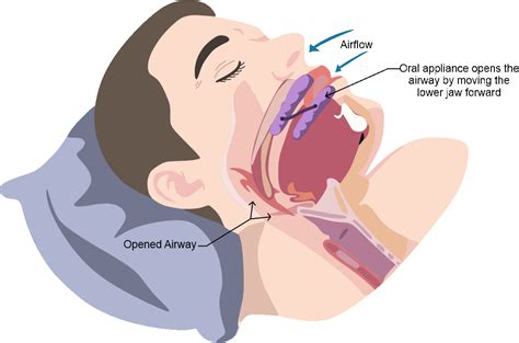 Houston Dental Sleep Therapy Oral Appliance Treatment