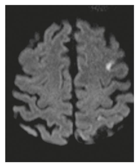 Bilateral Ischemic Lesions At The Left Cortical Frontal Lobe In Flair Download Scientific