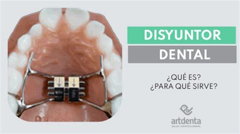 Disyuntor dental Qué es Para qué sirve Clínica Dental en