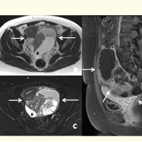 Solid Parts In The Large Adnexal Cystic Mass Arrows Mass Show Download Scientific Diagram