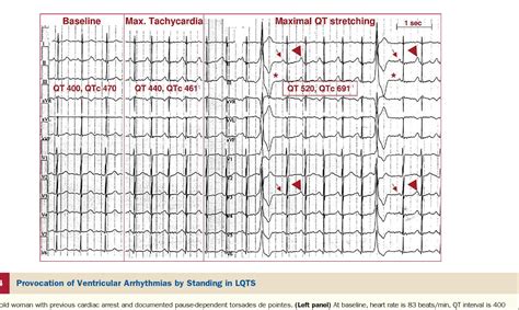 Figure 4 From The Response Of The Qt Interval To The Brief Tachycardia