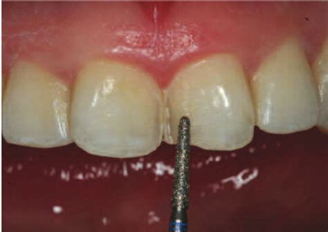 Interproximal Surface Of The Tooth Definition At Alanna Knowles Blog