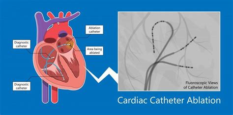Atrial Flutter Ablation Indications Virnetworks