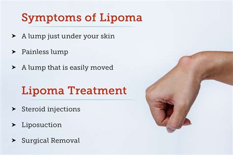 Understanding Lipoma Causes Symptoms And Treatment Ask The Nurse