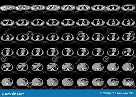 Ct Scan Abdomen Of The Patient`s Diffuse Bronchial Wall Thickening And