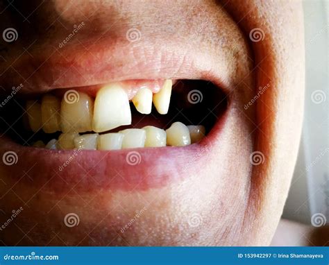 The Male Grinded His Teeth For Porcelain Crowns Or Veneers Stock Image